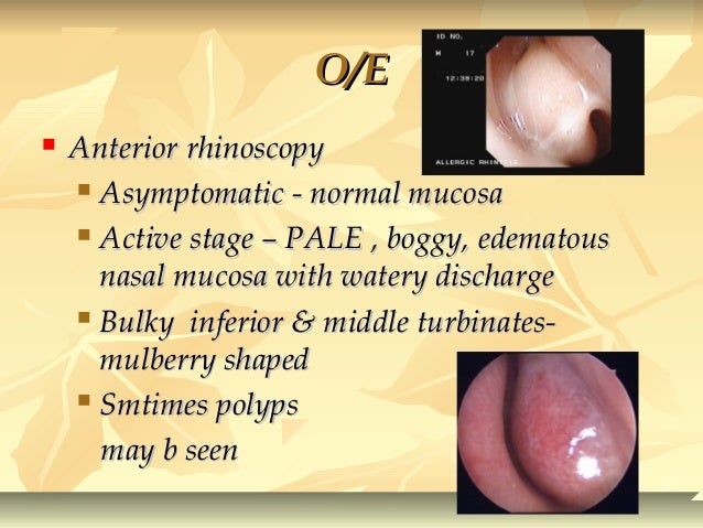 Clinical features and investigations of allergic rhinitis
