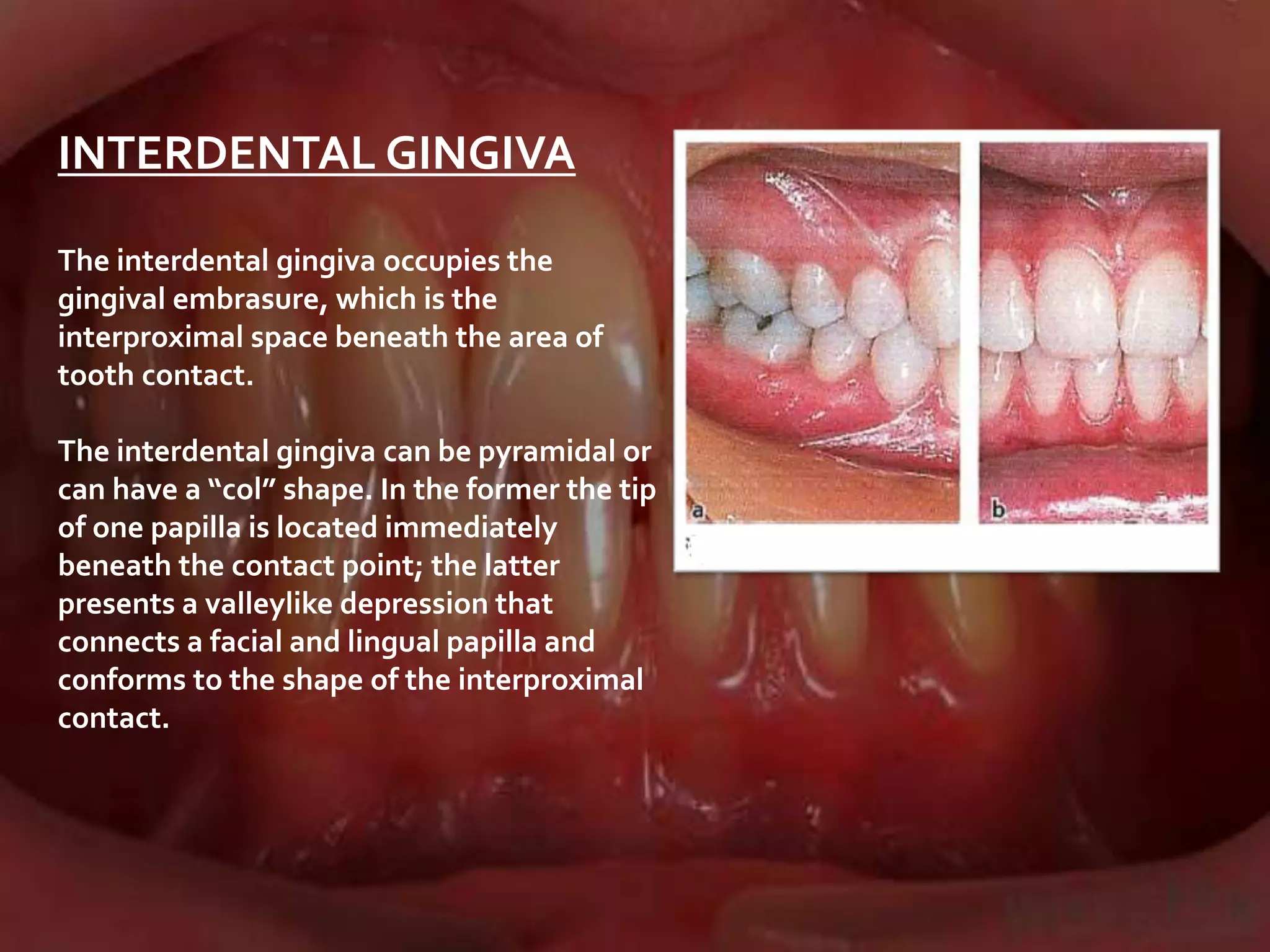 Clinical features and stages of gingivitis | PPTX