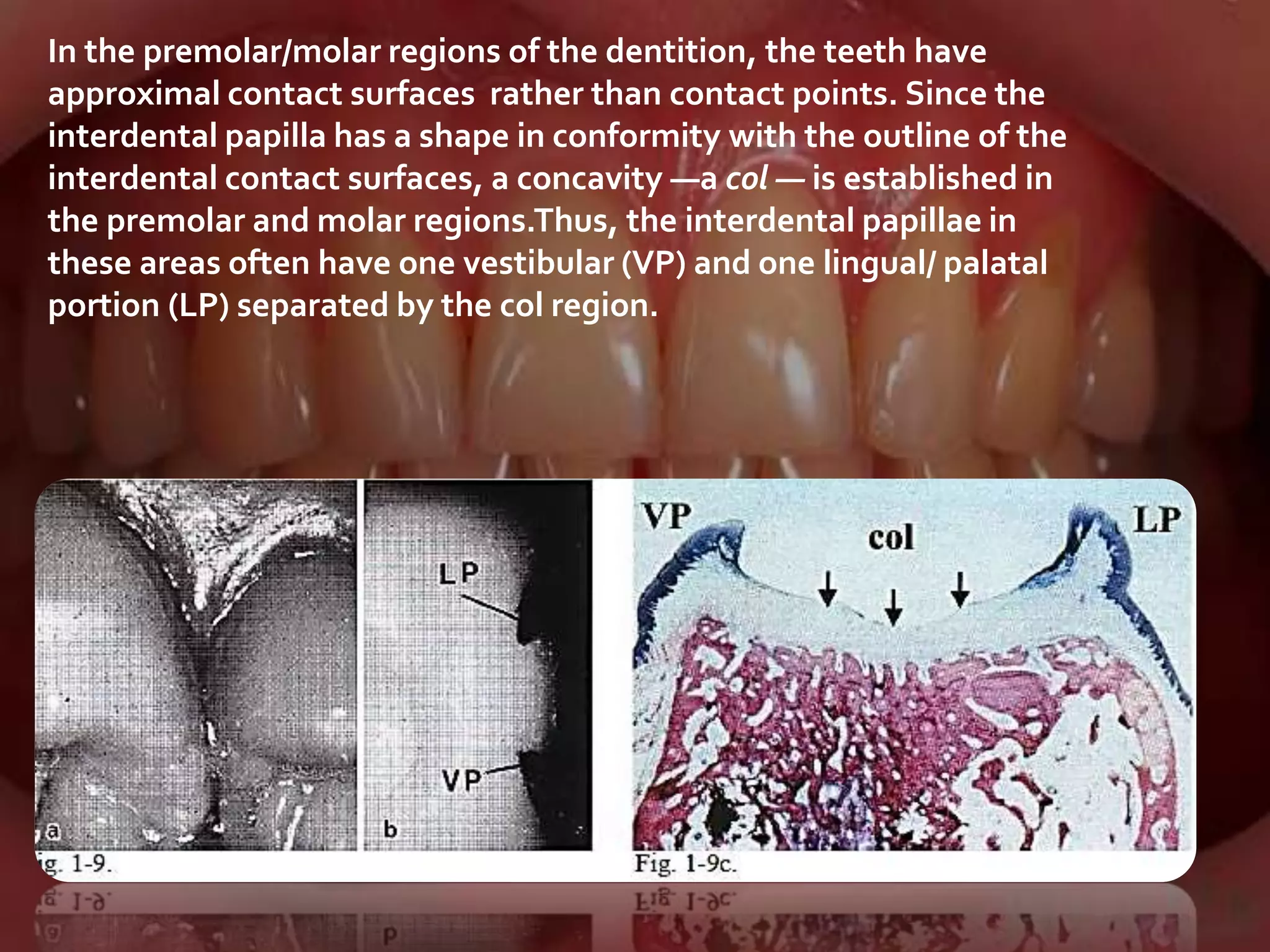 Clinical features and stages of gingivitis | PPTX