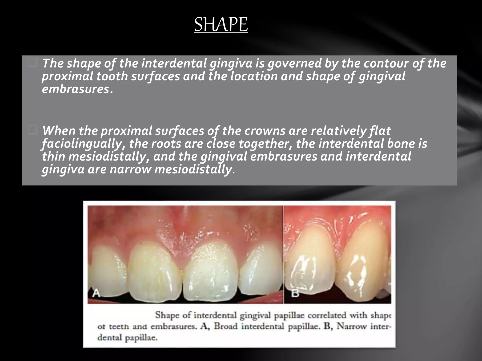 Clinical features and stages of gingivitis | PPTX