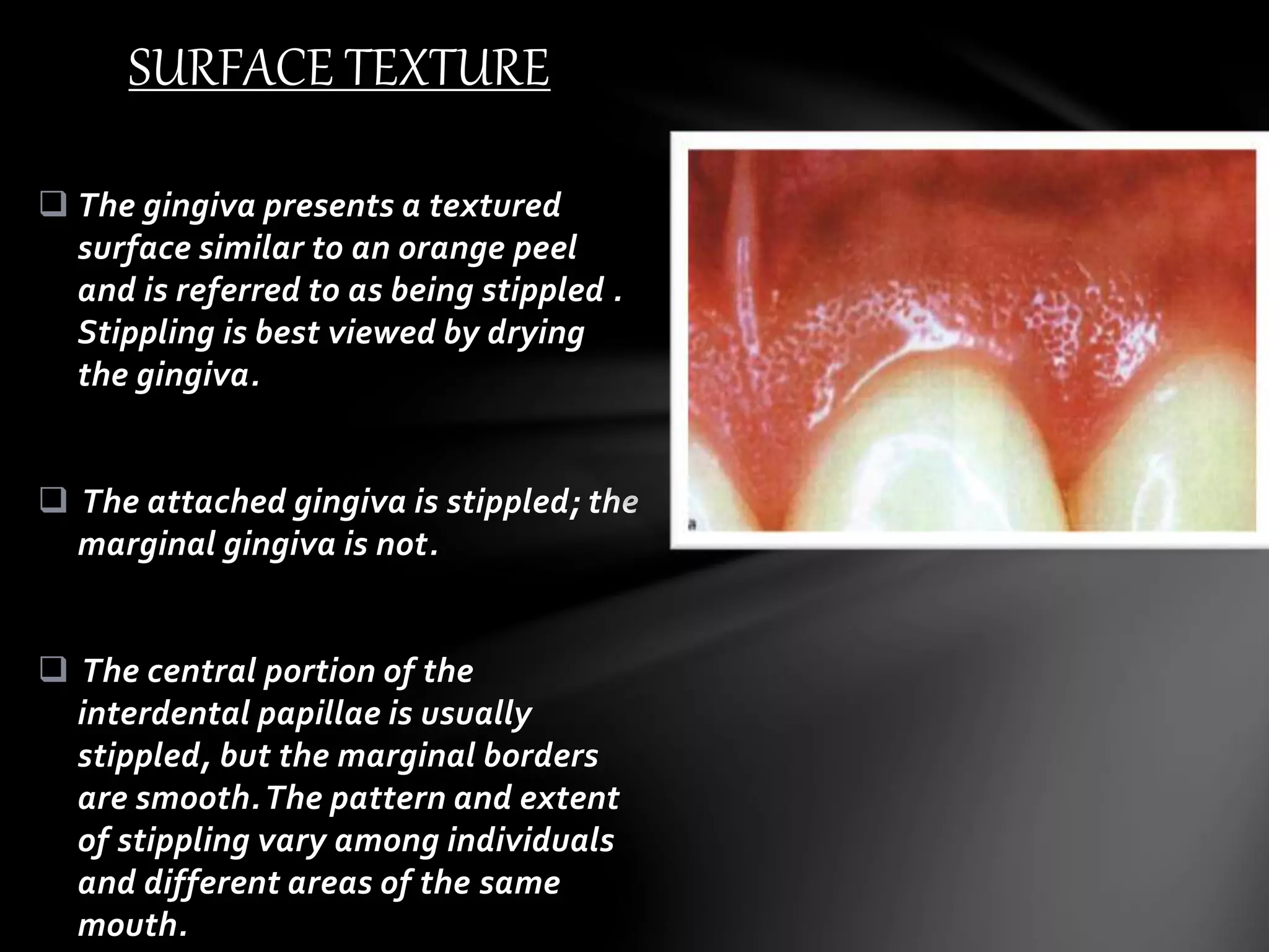 Clinical features and stages of gingivitis | PPTX