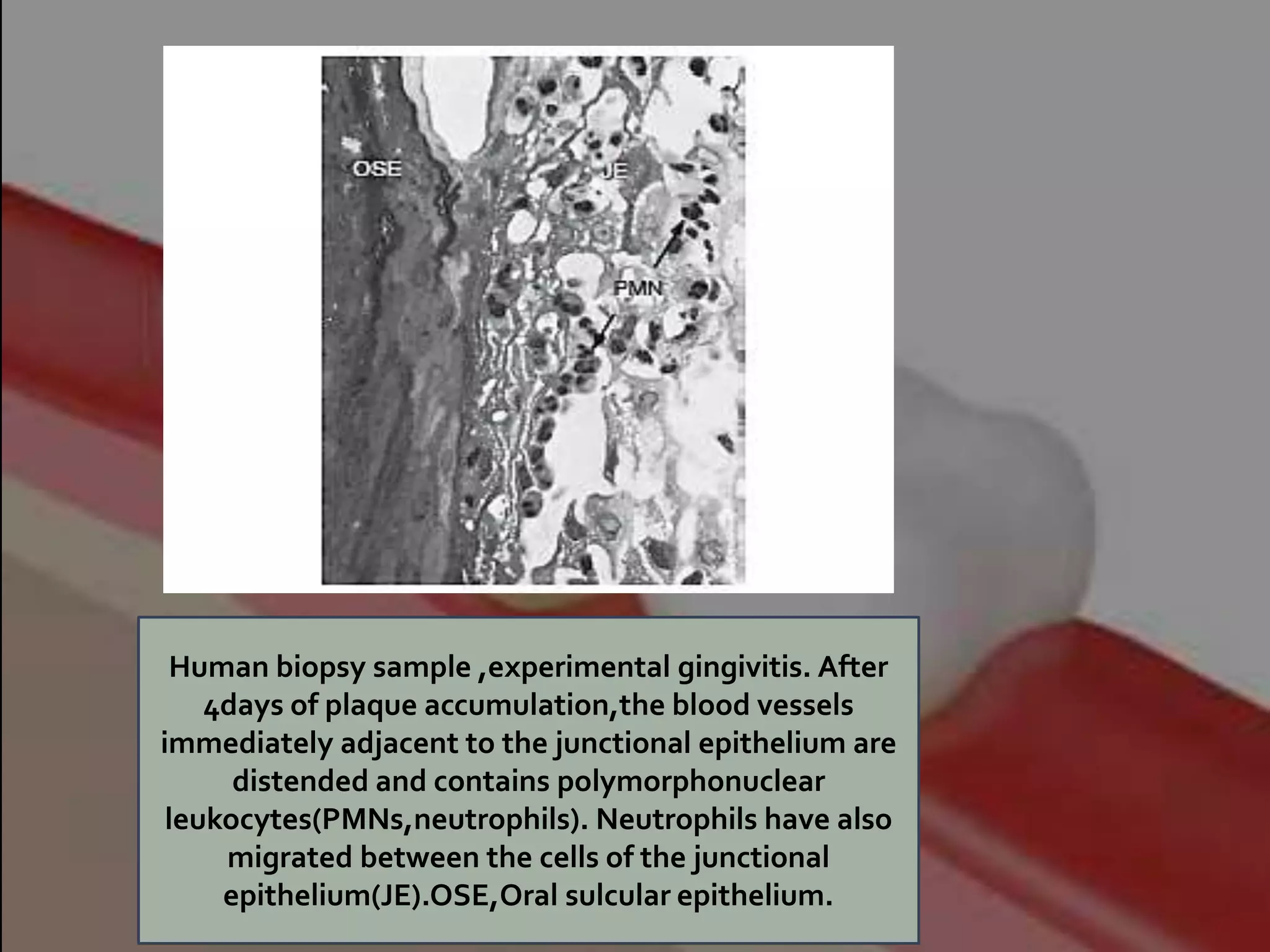 Clinical features and stages of gingivitis | PPTX
