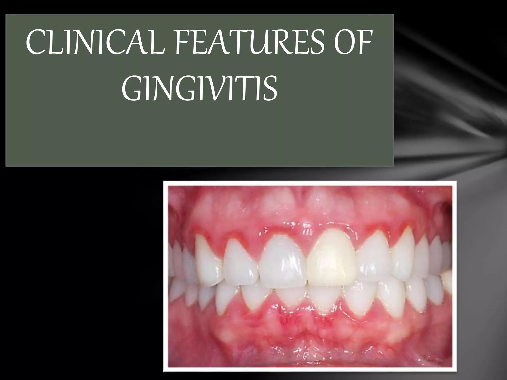 Clinical features and stages of gingivitis | PPTX