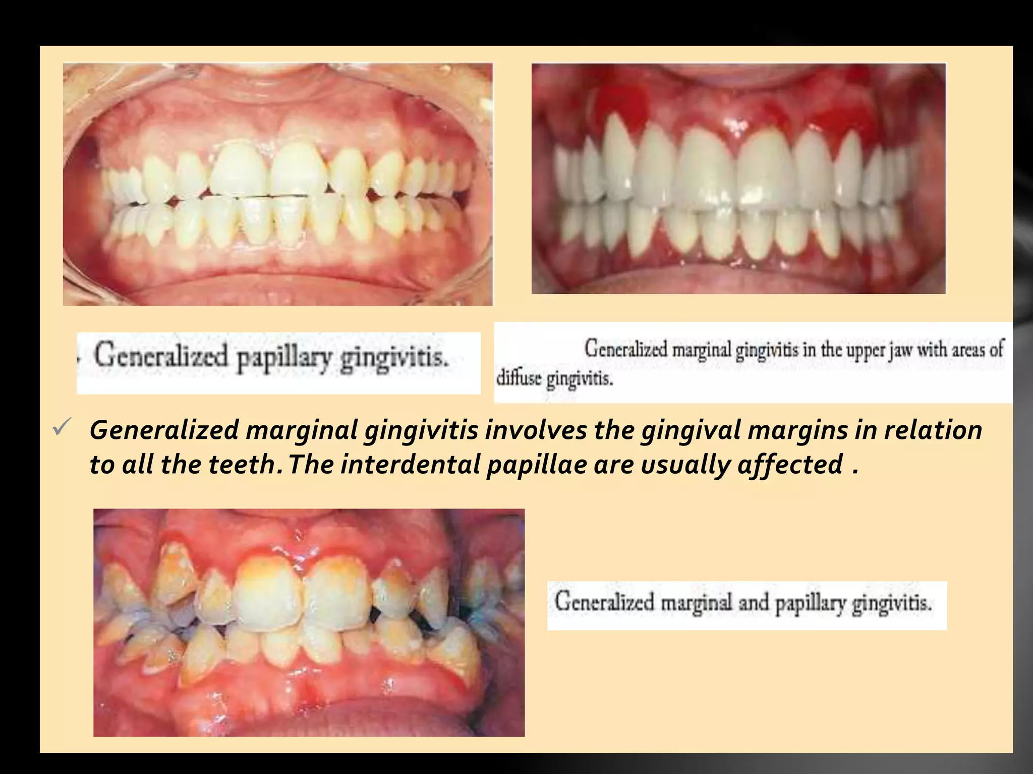 Clinical features and stages of gingivitis | PPTX
