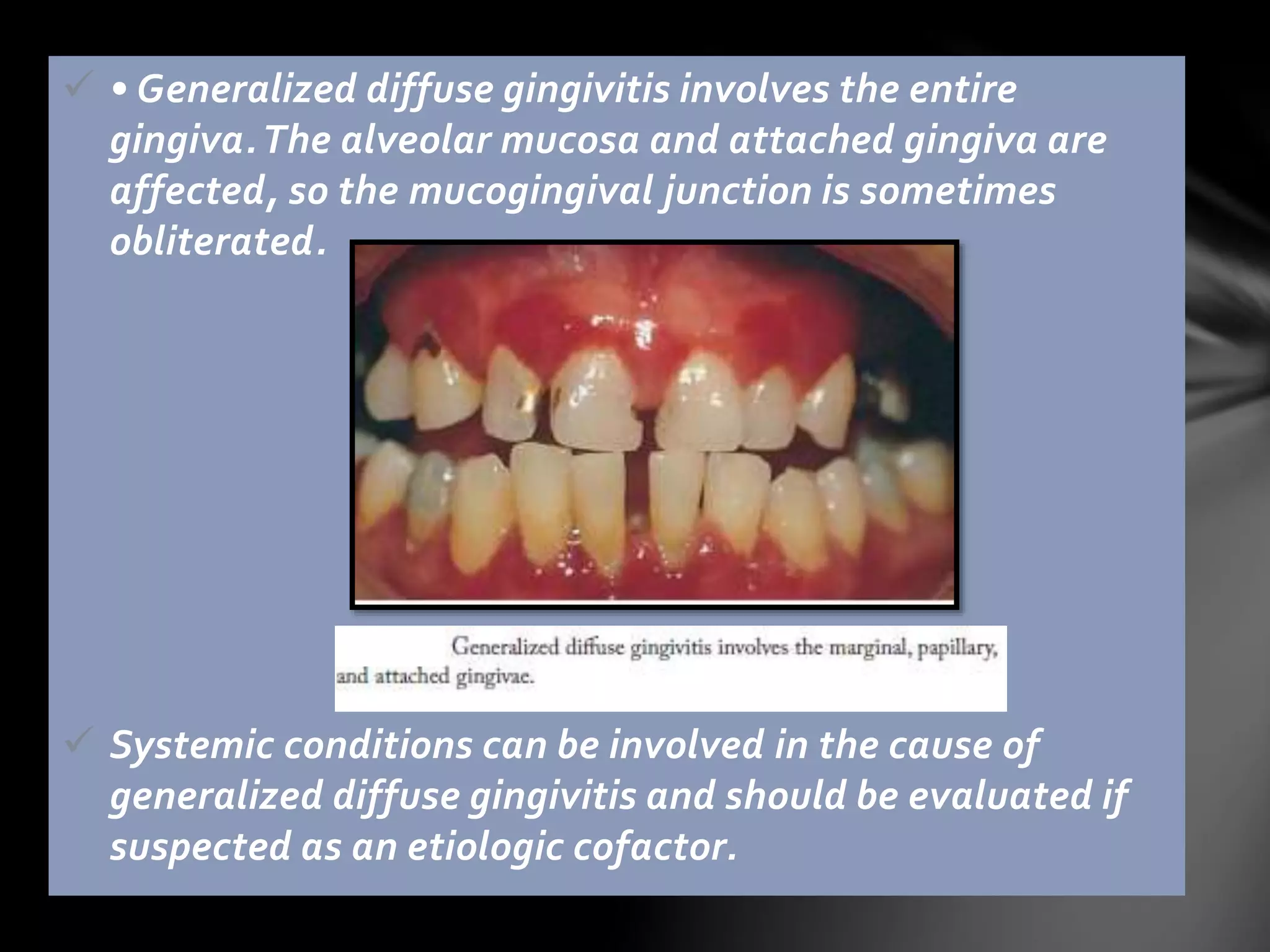 Clinical features and stages of gingivitis | PPTX