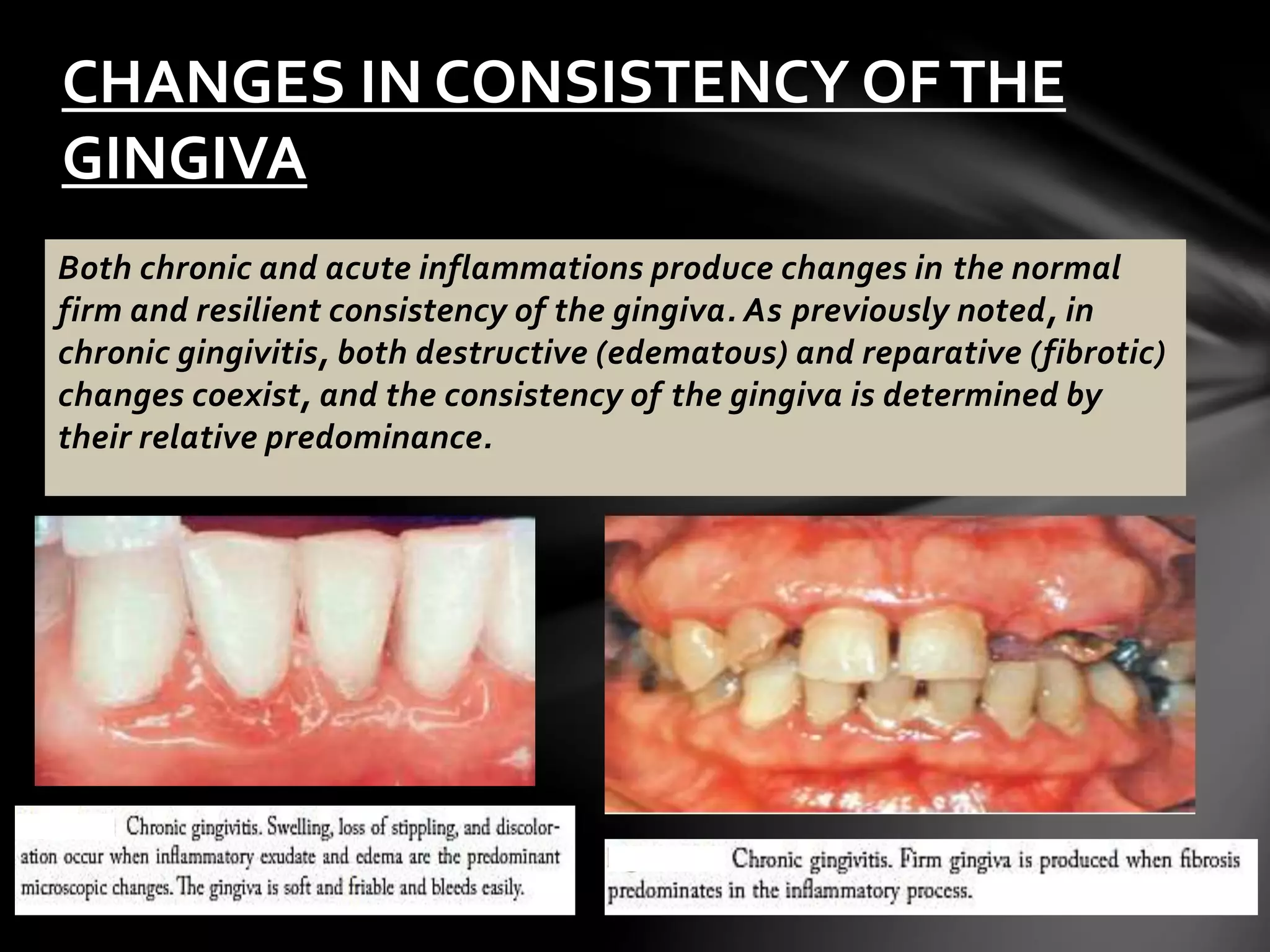 Clinical features and stages of gingivitis | PPTX