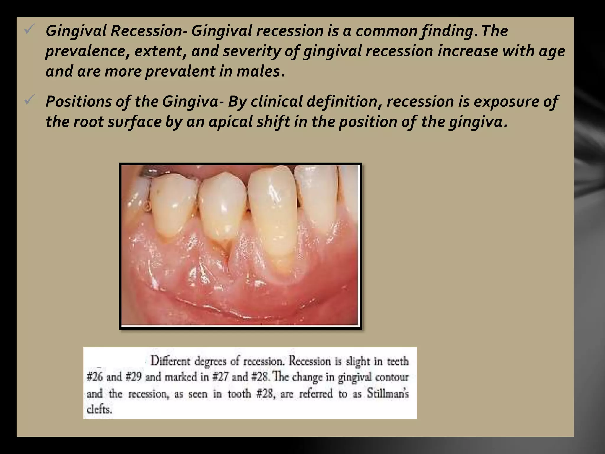 Clinical features and stages of gingivitis | PPTX