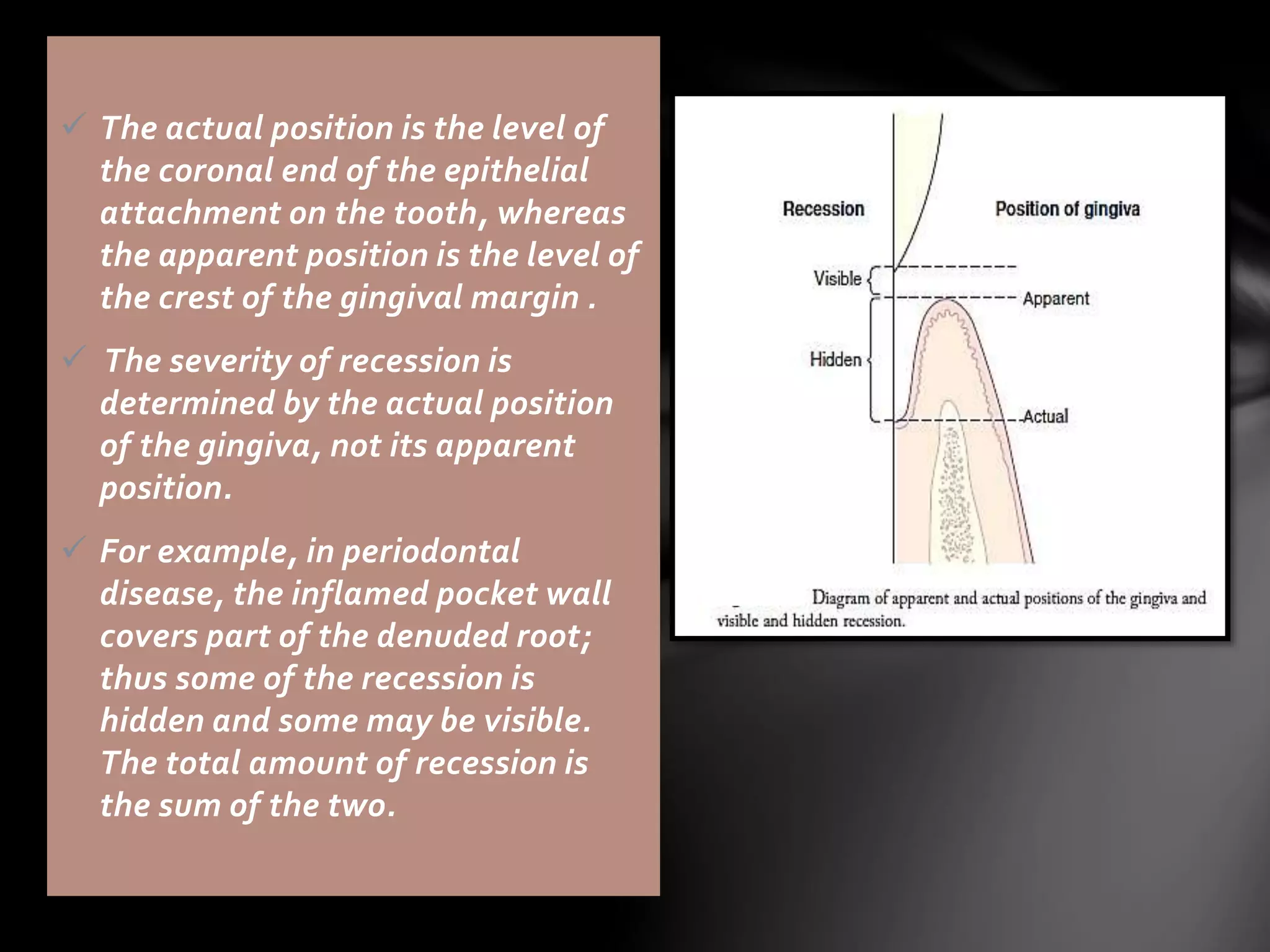Clinical features and stages of gingivitis | PPTX