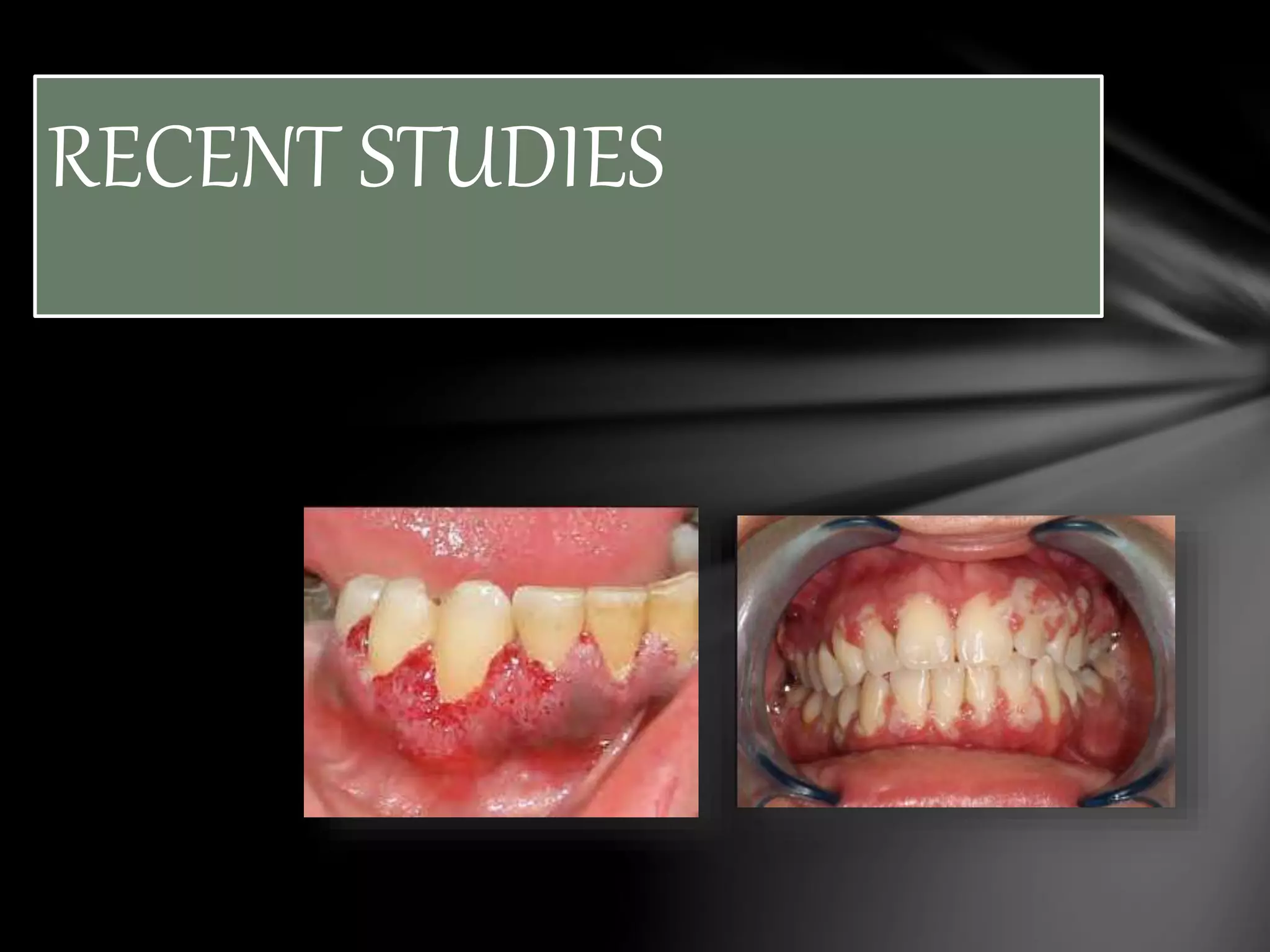 Clinical features and stages of gingivitis | PPTX