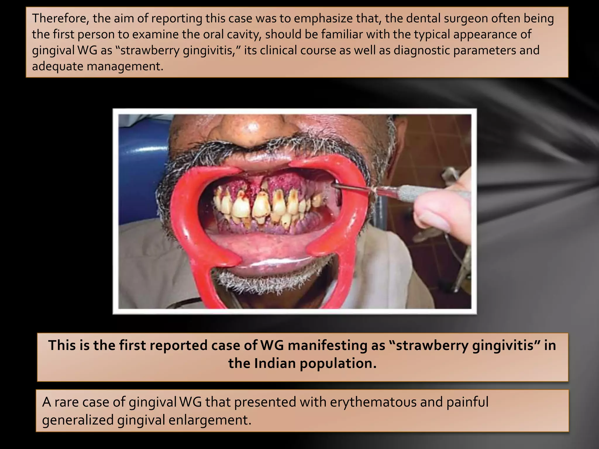 Clinical features and stages of gingivitis | PPTX