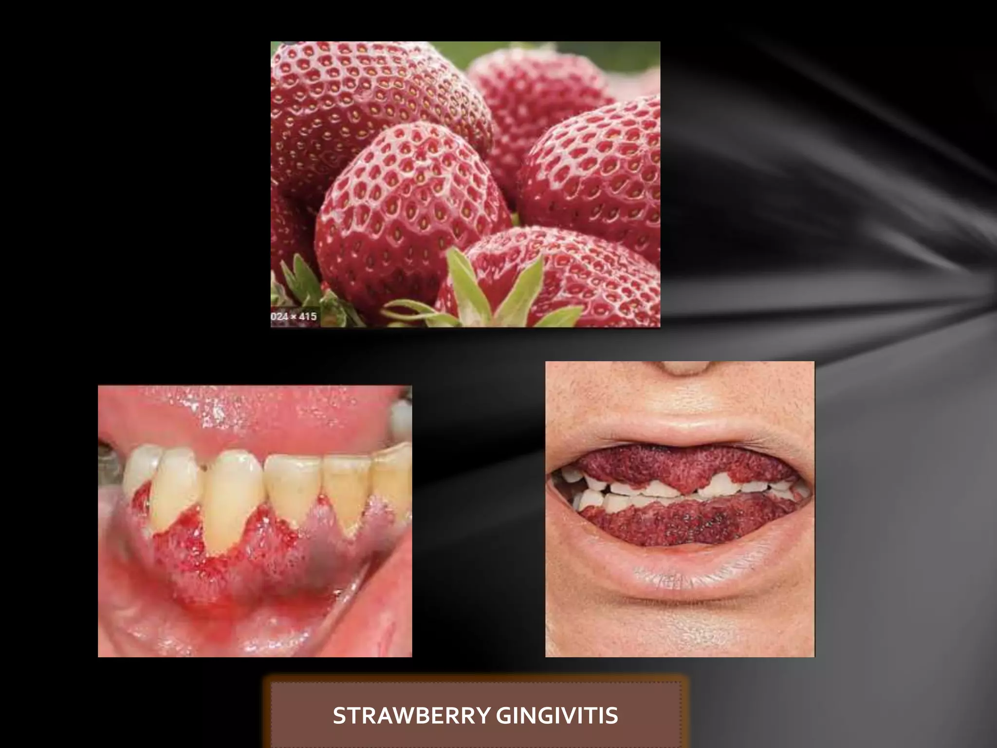 Clinical features and stages of gingivitis | PPTX