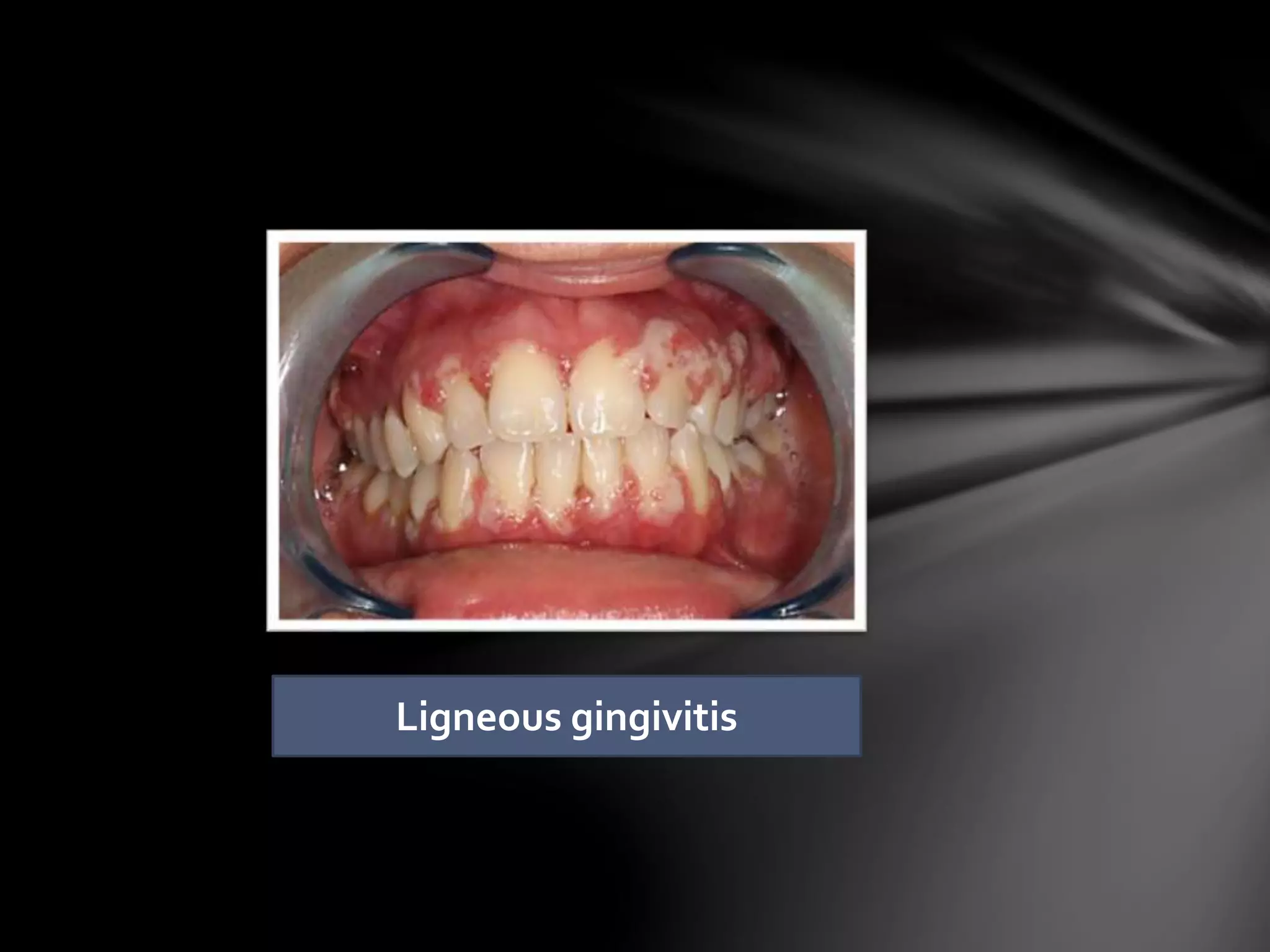 Clinical features and stages of gingivitis | PPTX