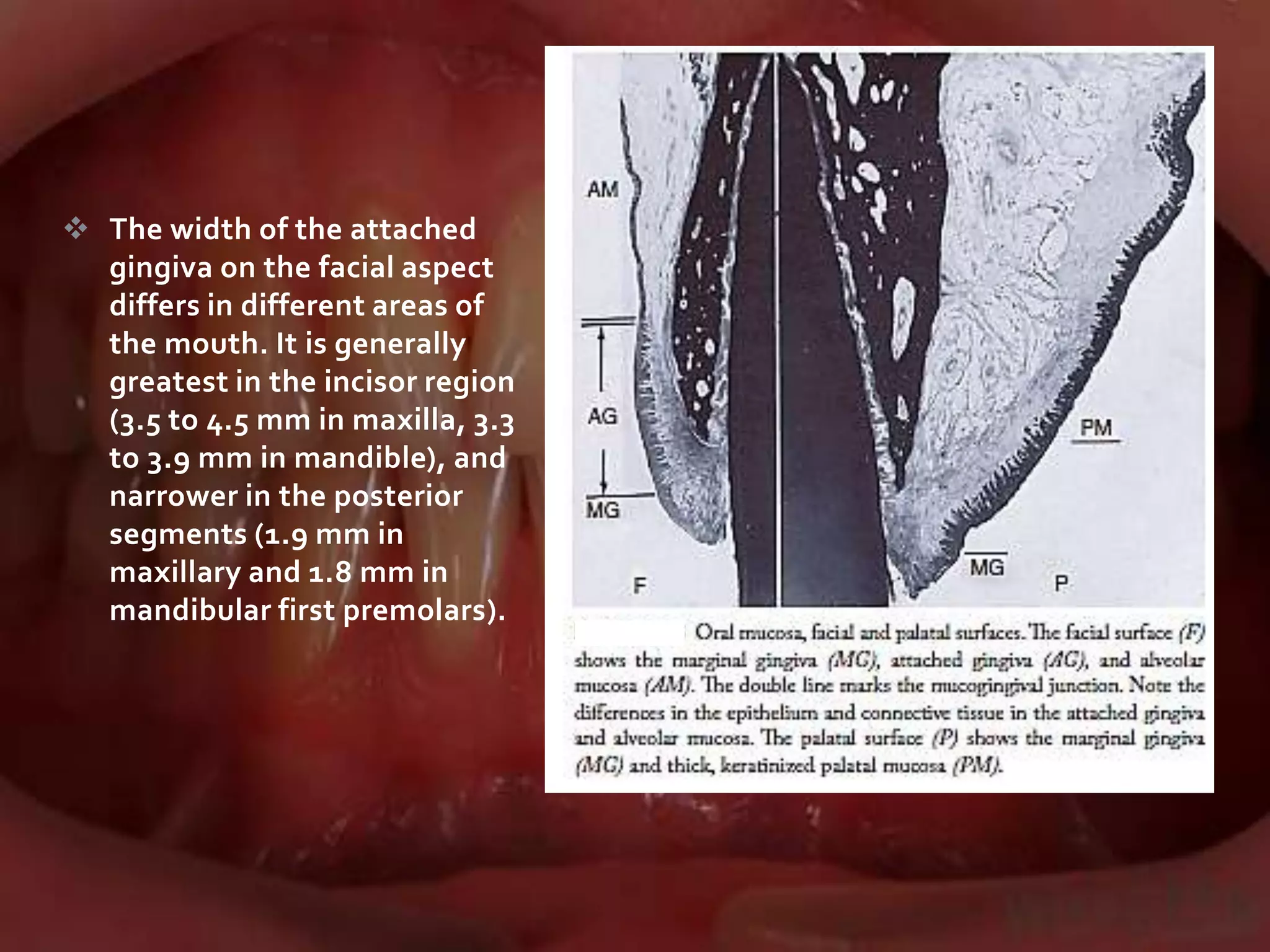 Clinical features and stages of gingivitis | PPTX