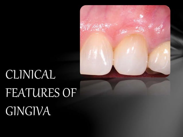 Clinical features and stages of gingivitis | PPTX