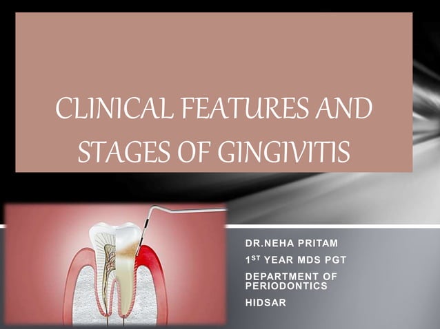 Clinical features and stages of gingivitis | PPTX