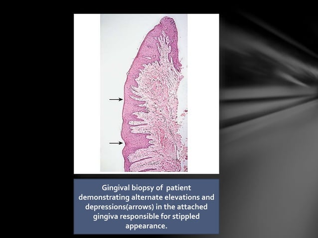 Clinical features and stages of gingivitis | PPTX