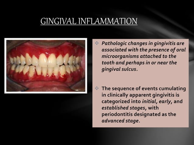 Clinical features and stages of gingivitis | PPTX