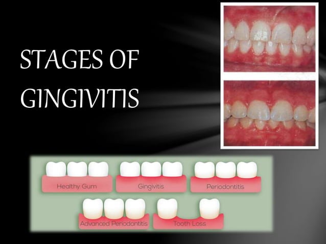 Clinical features and stages of gingivitis | PPTX