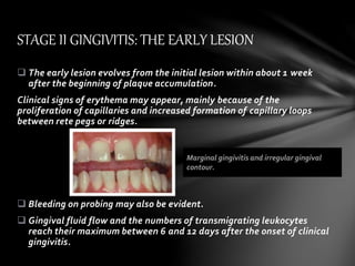 Clinical features and stages of gingivitis | PPTX