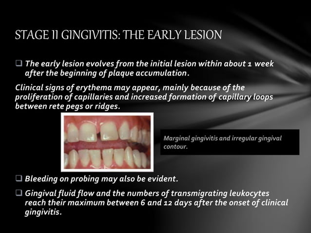 Clinical features and stages of gingivitis | PPTX