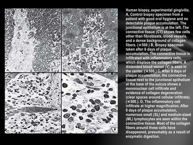 Clinical features and stages of gingivitis | PPTX