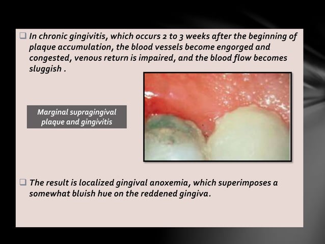 Clinical features and stages of gingivitis | PPTX