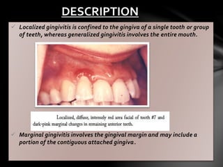 Clinical features and stages of gingivitis | PPTX