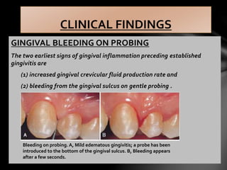 Clinical features and stages of gingivitis | PPTX