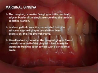 Clinical features and stages of gingivitis | PPTX