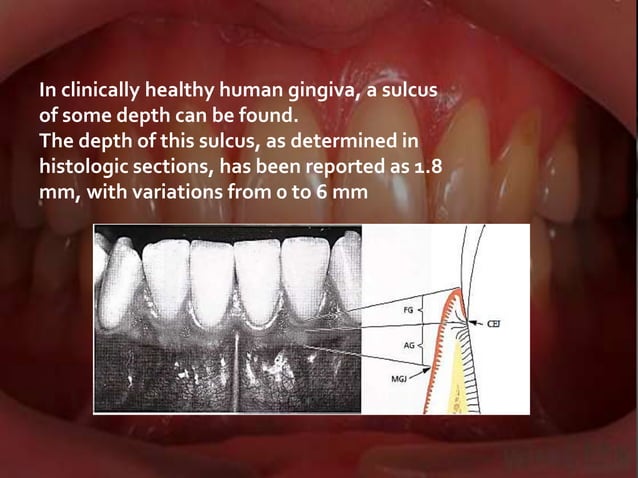 Clinical features and stages of gingivitis | PPTX