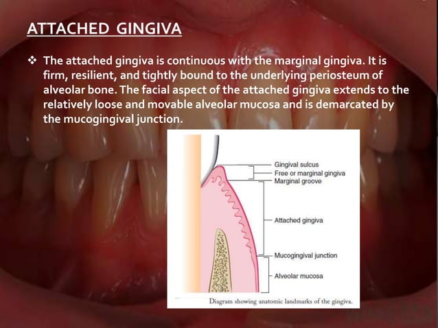 Clinical features and stages of gingivitis | PPTX