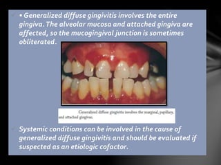 Clinical features and stages of gingivitis | PPT