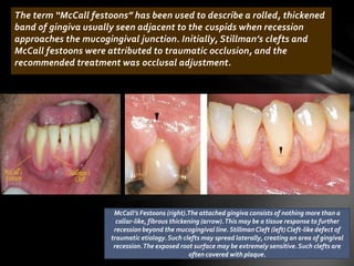 Clinical features and stages of gingivitis | PPT
