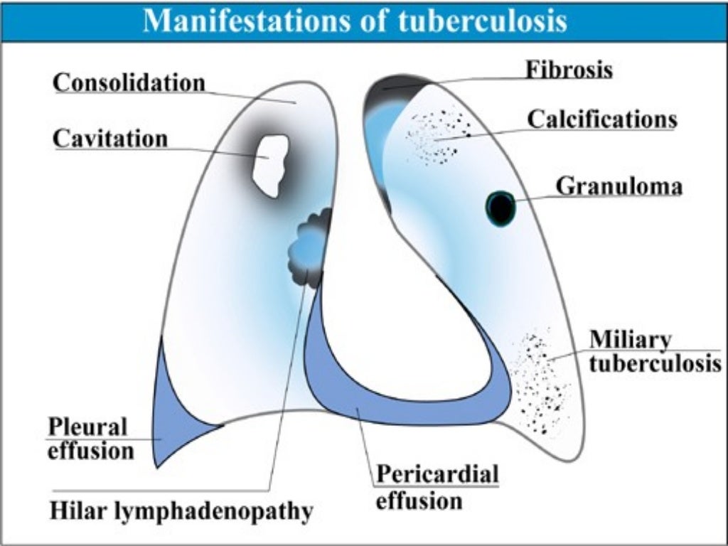 Clinical features,diagnosis and treatment of tuberculosis