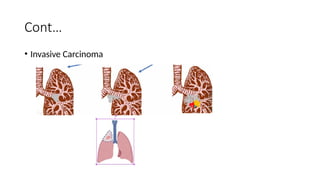 Classification, Histology and Clinical Features of Lung Cancer | PPTX