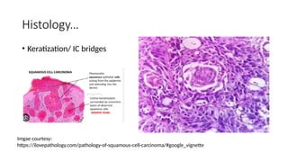 Classification, Histology and Clinical Features of Lung Cancer | PPTX