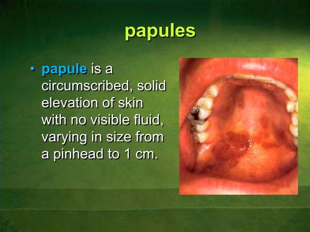 Clinical features of allergic stomatitis | PPTX