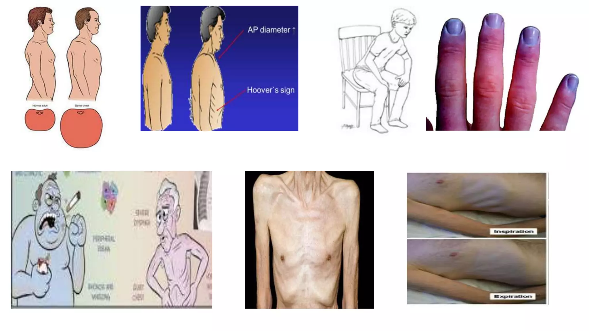 CLINICAL FEATURES OF COPD.pptx