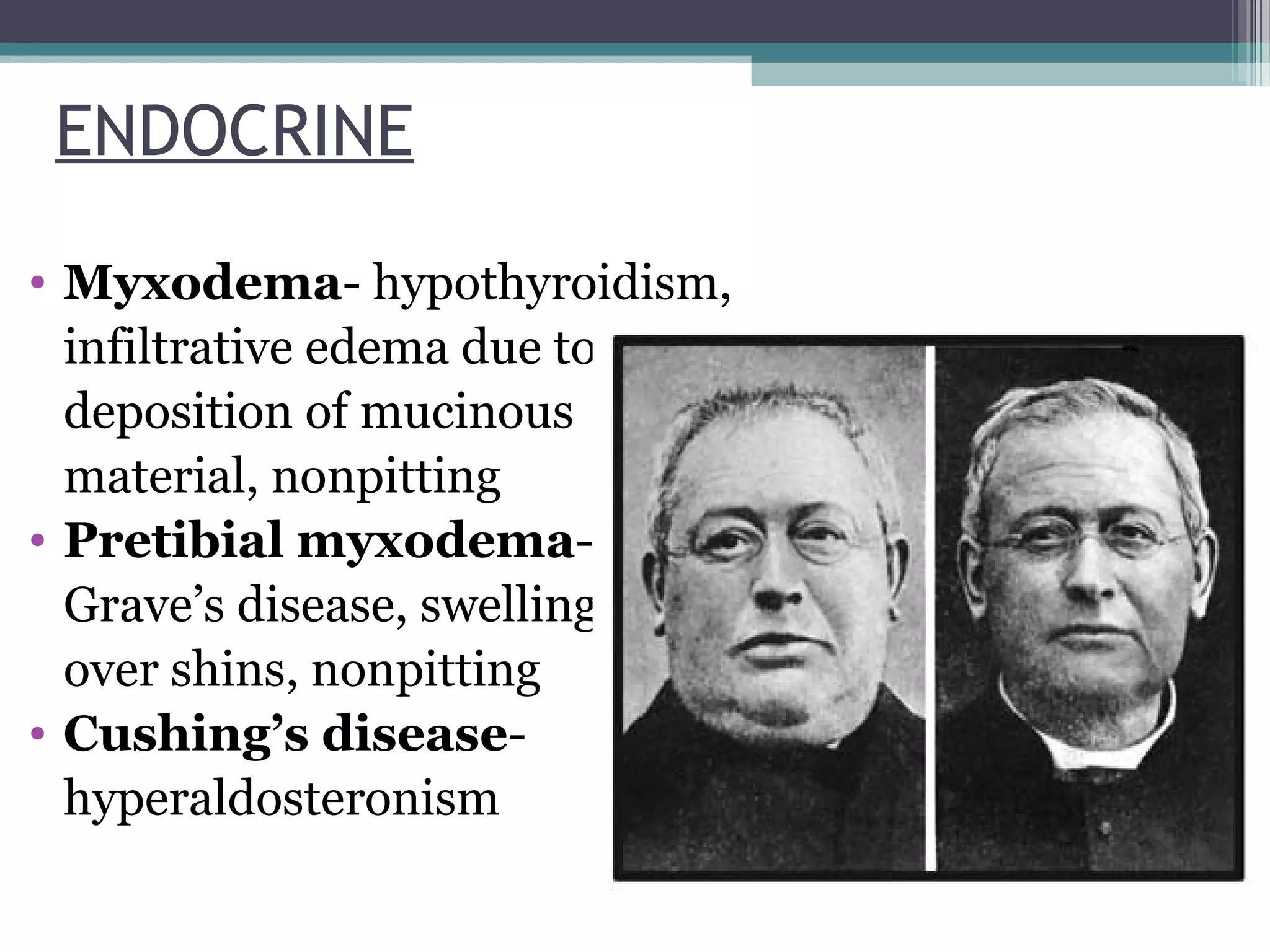 Clinical features of edema | PPT