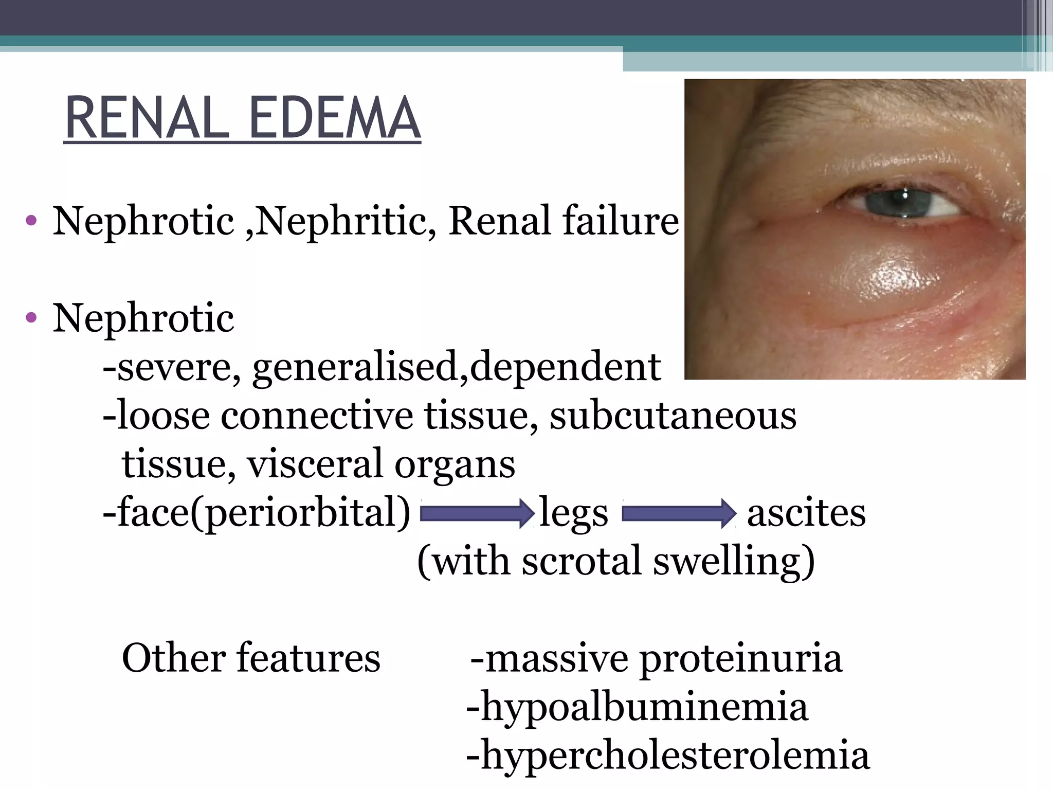 Clinical features of edema | PPT | Heart and Cardiovascular Diseases ...