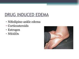Clinical features of edema | PPT
