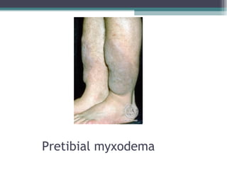 Clinical features of edema | PPT