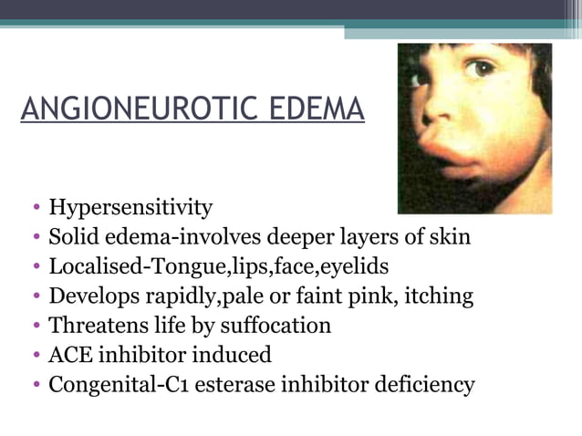 Clinical features of edema | PPT | Heart and Cardiovascular Diseases ...