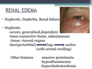 Clinical features of edema | PPT | Heart and Cardiovascular Diseases ...