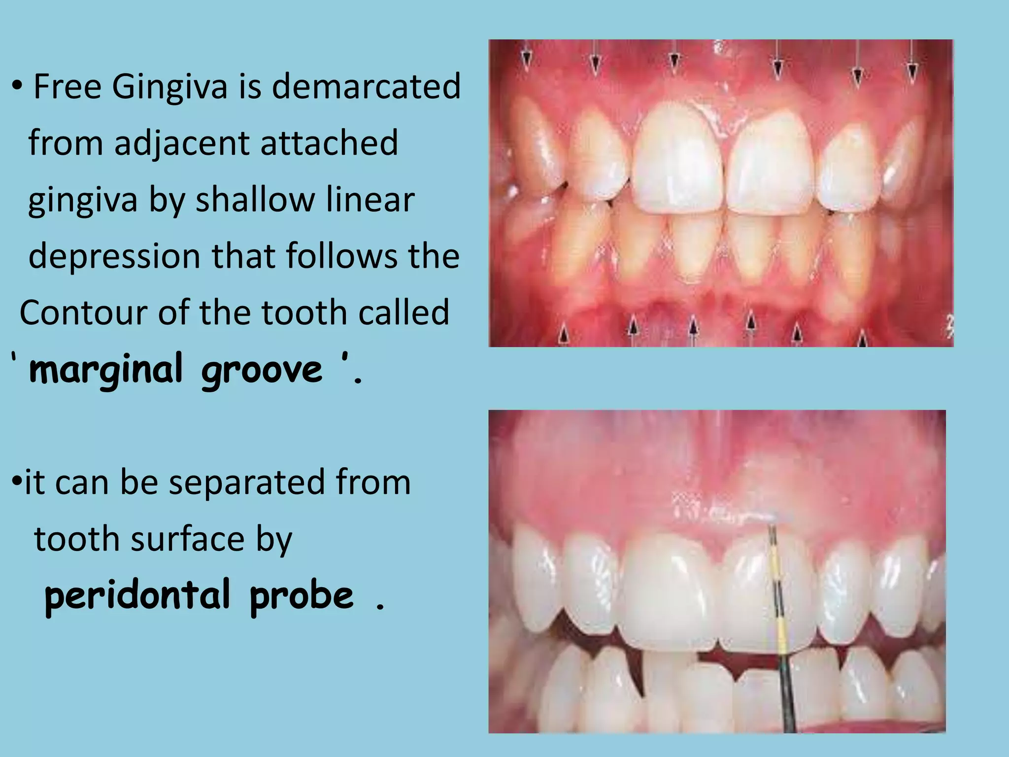 Clinical features of gingiva | PPTX