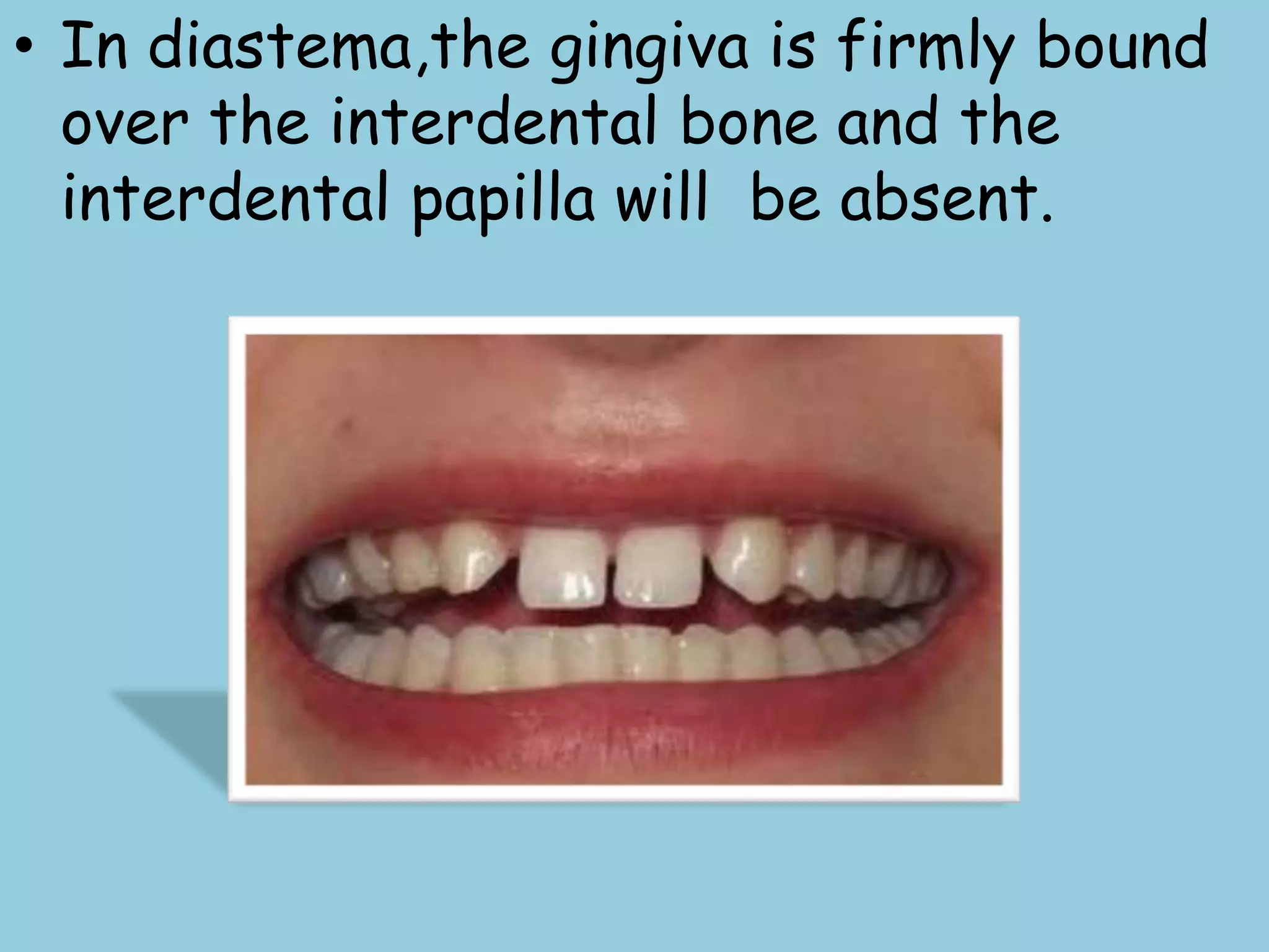 Clinical features of gingiva | PPTX