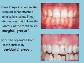 Clinical features of gingiva | PPTX