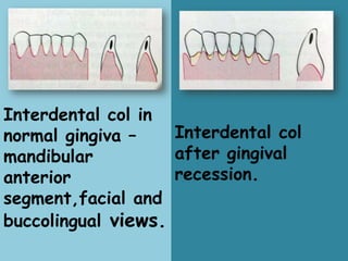 Clinical features of gingiva | PPTX