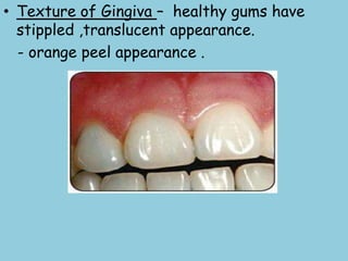 Clinical features of gingiva | PPTX