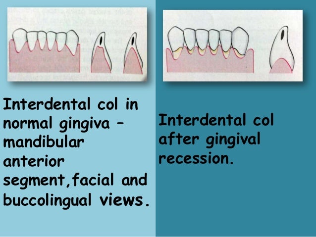 Clinical features of gingiva